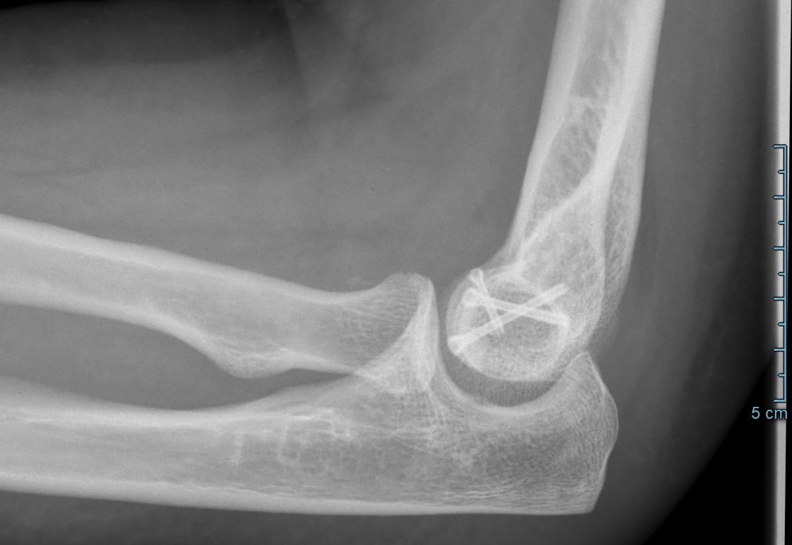 Heidemann - Hand- und Ellenbogenchirurgie in Hürth - Frakturen ...