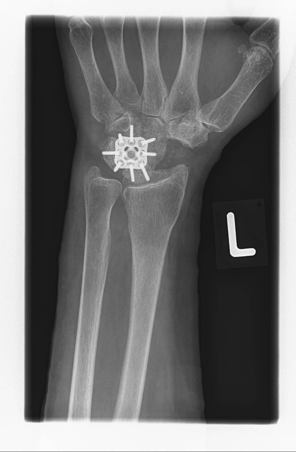 Handgelenksteil- oder -totalversteifungen